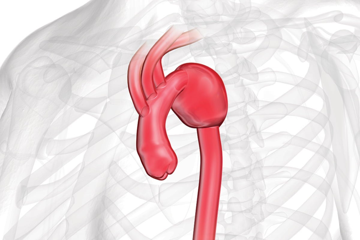 胸部大動脈疾患 | 日本ゴア メディカル製品