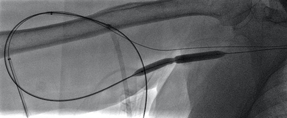 VIABAHN® for Treating Thrombosed AV Access Grafts | Gore Medical