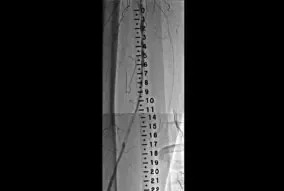 In-stent restenosis of the SFA | VIABAHN® | Gore Medical