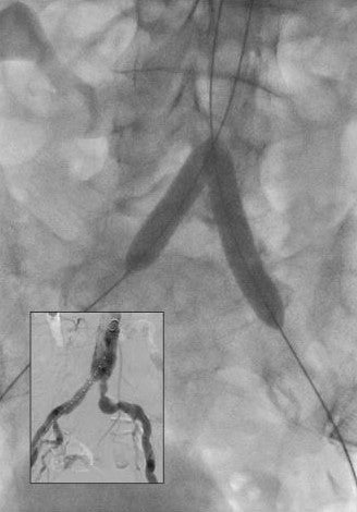 Durable Results in Tortuous Anatomy: VBX Case Study on Conformability ...