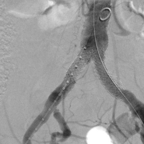 Achieving conformability and durable results in tortuous anatomy | Case ...