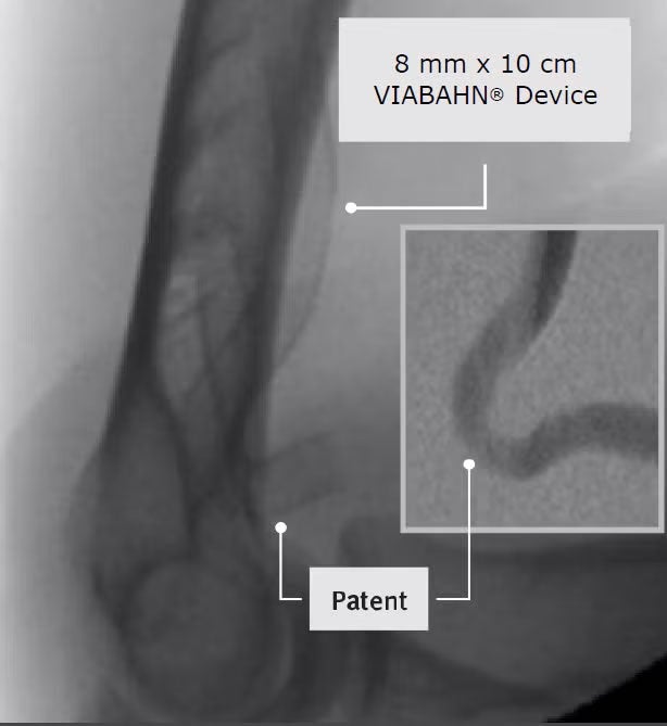GORE® VIABAHN® Endoprosthesis – Clinical data – AV access 6-month data ...